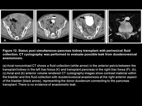 Genitourinary Learning Modules Ct Scanning