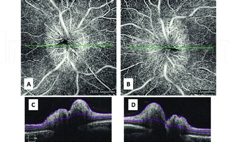 Gcc Imaging 3 Months After Acute Papilledema The Imaging Shows A