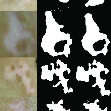 Sample Comparisons Of Lesion Segmentation Between Unet Architecture