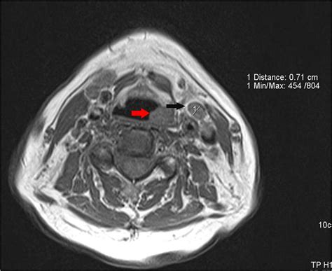 Pyriform Sinus J Med Cases