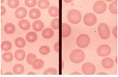 Macrocytic Anemia