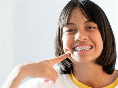 Difference Between Ceramic Braces And Invisalign At Jordan Old Blog