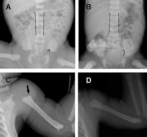 Achondroplasia X Ray Findings