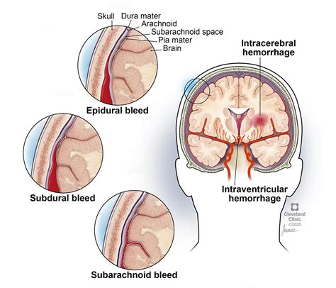 Acute Epidural Hematoma