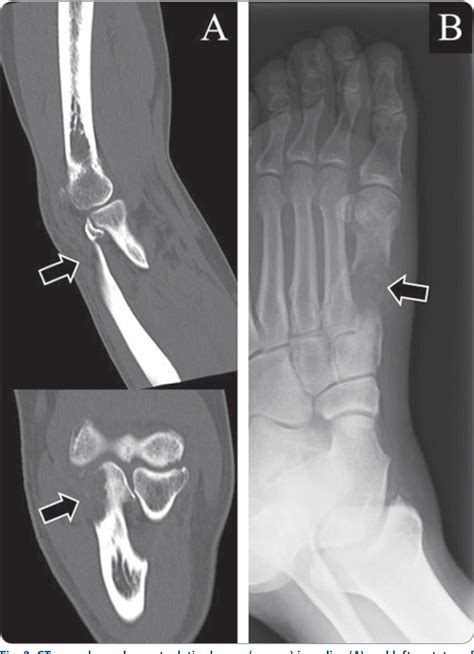 Figure 2 From Rapidly Progressive Squamous Cell Lung Cancer With Met Exon 14 Skipping Mutation