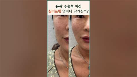 윤곽 양악 수술후 얼굴 처짐 리프팅 개선 방법 전후비교 실리프팅 안면거상 울쎄라 Modsclinic 스컬트라 Youtube