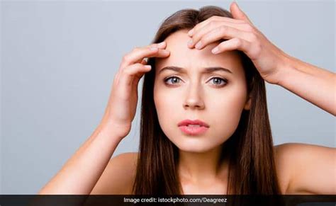 Forehead Acne Caused By Bangs Heres What Dermatologist Dr Jaishree Sharad Says