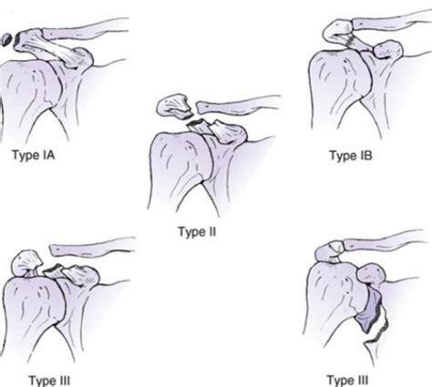 Scapula Fractures Core Em