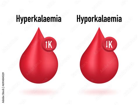 Hyperkalaemia High Plasma Potassium Level And Hypokalaemia Low Plasma Potassium Level