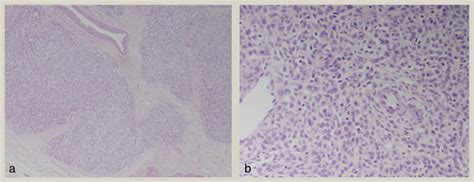 New Developments In Endometrial Stromal Sarcoma Diagnostic Histopathology