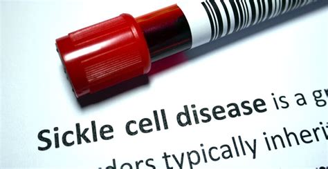Curative Exa Cel Gene Therapy Approved In Europe For Severe Sickle Cell