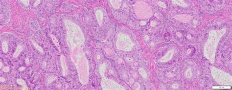 Human Ovary Cancer Endometrioid Adenocarcinoma Ffpe Sections
