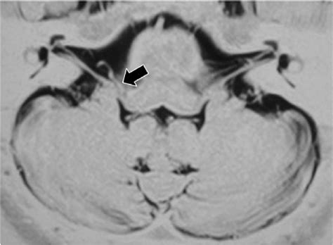 Preoperative Magnetic Resonance Image From A Patient With Right Download Scientific Diagram