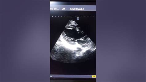 Echo Cases Assess Rwma Youtube