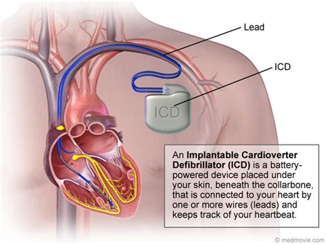 Implantable Cardioverter Defibrillator Subcutaneous Implantable