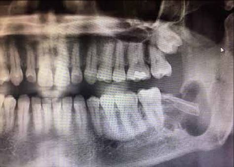 Decompression Stent Secured To Patient 1 During Marsupialization And Download High
