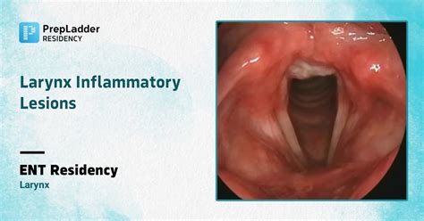 Larynx Inflammatory Lesions Causes And Treatment