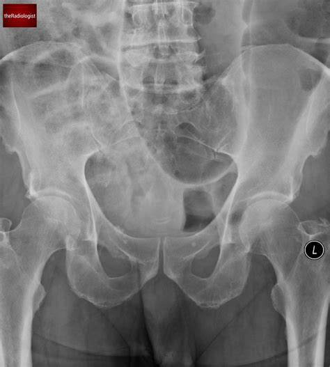 Sigmoid Volvulus The Radiologist