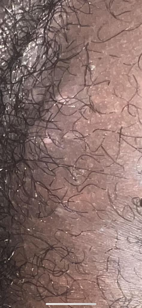 Are These Folliculitis R Folliculitis