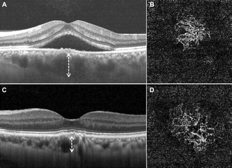 Representative Oct And Octa Images In The Two Groups A And B Download Scientific Diagram