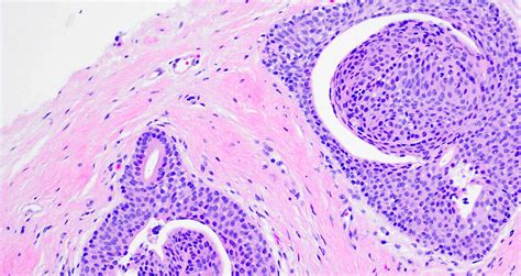 Metaplasia Apocrina Metaplasia Apocrina