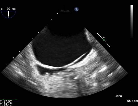 Bubble Study On Transesophageal Echocardiography RK MD