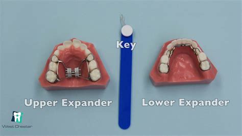 How To Adjust Palate Expander At Jerry Gavin Blog