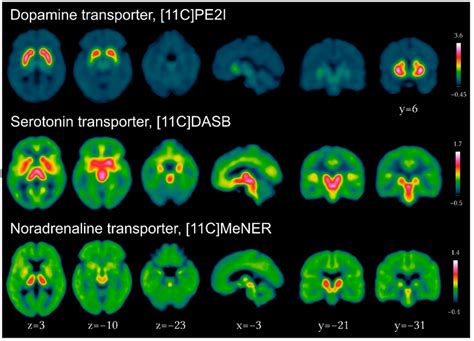 Imaging Of The Presynaptic Dopaminergic Serotonergic And Noradrenergic