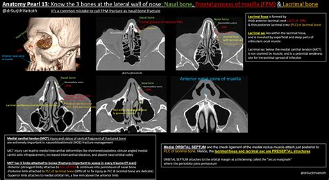 Nasal Bone Xray Midface Diagnosis Nasal Noe Nasal Bone Ao