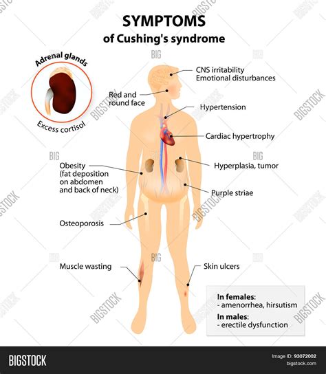 Cushings Disease Thyroid At Johnny Moe Blog
