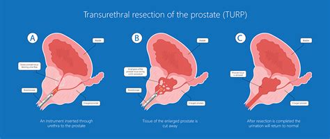 Transurethral Resection Of The Prostate Stricture Urine Bladder Aaurology