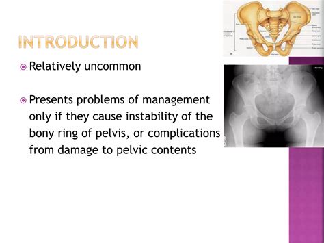 Fractures Pelvispptx