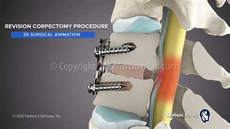 3d Surgery Animation Portrays Revision Vertebral Corpectomy Youtube