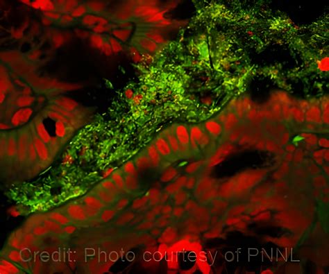 Hidden Influence Of Gut Microbiome On Early Onset Colorectal Cancer