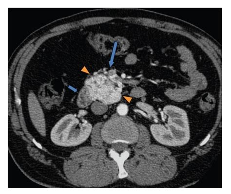 Axial Contrast Enhanced Ct Abdomen Shows A Hypervascular Download