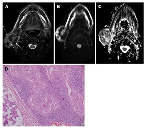 Benign Neck Masses Showing Restricted Diffusion Is There A