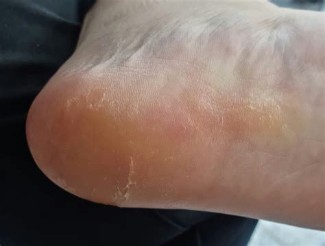 발바닥 굳은살 지식in