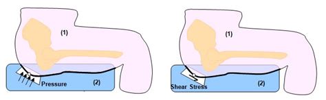 Lets Get It Clear Pressure Shear And Friction At Today Assistive Technology