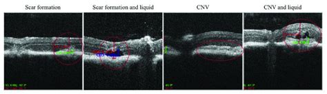 Spectral Domain Optical Coherence Tomography Imaging Of CNV Pathology Download Scientific