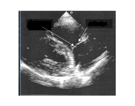 Rv Inflow Tv Leaflets Quiz