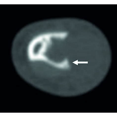 Photograph Shows A Slightly Protuberant Subcutaneous Mass In The