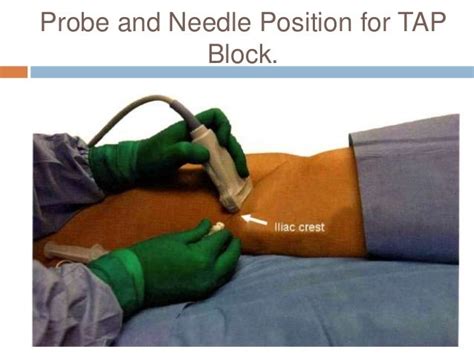 Ultrasound Guided Transversus Abdominis Plane Tap Block