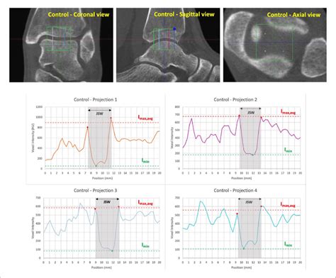 Control Ankle Computed Tomographic Ct Images In The Coronal