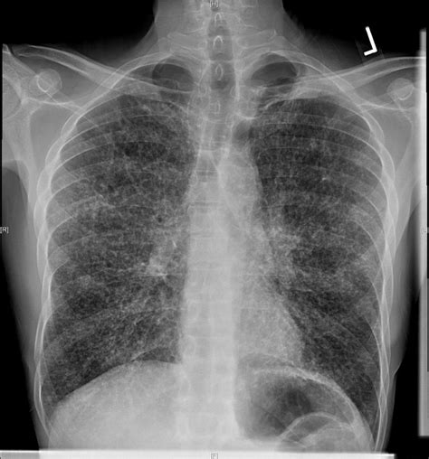 Does Chest X Ray Show Histoplasmosis At Steve Michelle Blog