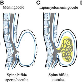 Schematic Representation Of Different Spina Bifida Subphenotypes A
