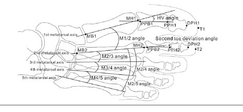 Figure 2 From Why Do Lesser Toes Deviate Laterally In Hallux Valgus A