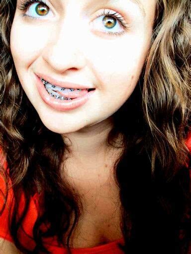 Her Eyes Are Gorgeous Brace Face Braces Smile Braces