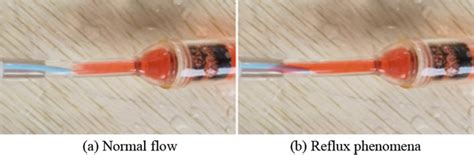 Control Of The Injection Velocity Of Embolic Agents In Embolization