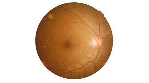 Blurry Vision How To Manage Eye Problems That Affect Your Daily Life