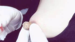 Porn Video Saline Injection On Grigtube Com 4 Sex Videos Saline Injection